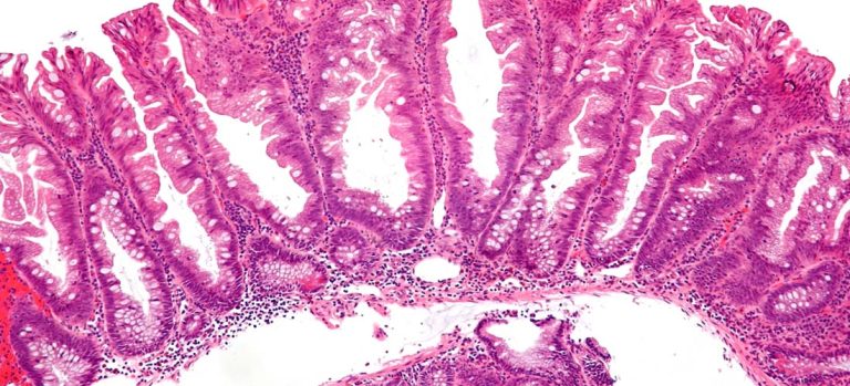 Blog - Sessile Serrated Polyps Share Risk Factors With Conventional ...