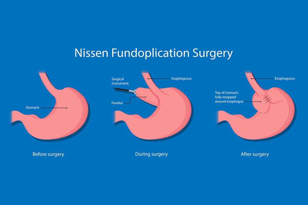 A Concise Guide To Fundoplication Process For Antireflux Surgery A Concise Guide To Fundoplication Process For Antireflux Surgery
