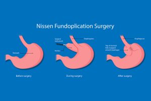 A Concise Guide to Fundoplication Process for Antireflux Surgery